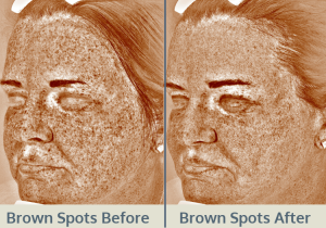 Canfield VISIA Camera System | Plymouth Meeting Dermatology