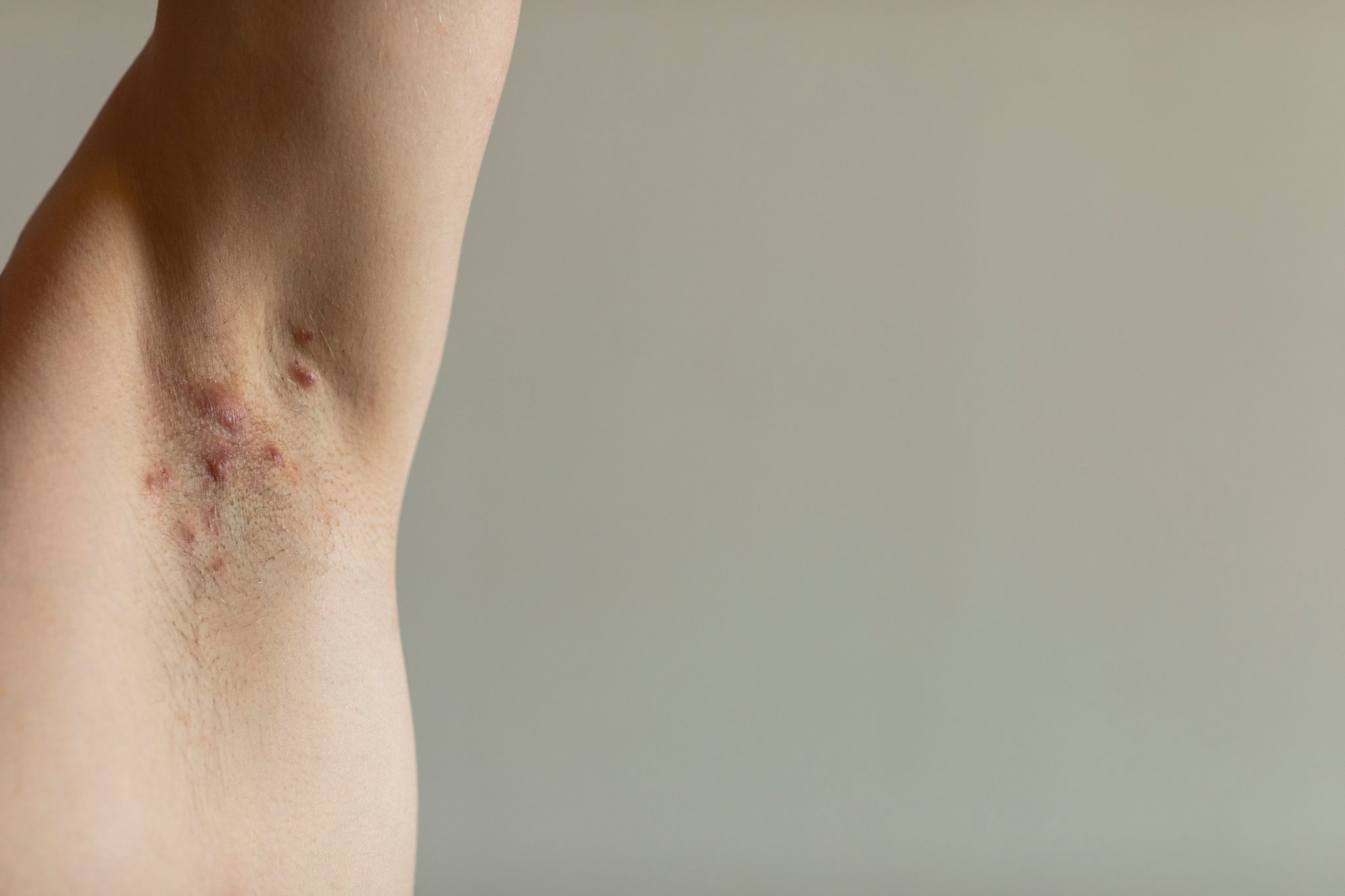 Hidradenitis Suppurativa: Symptoms, Causes, and Treatments