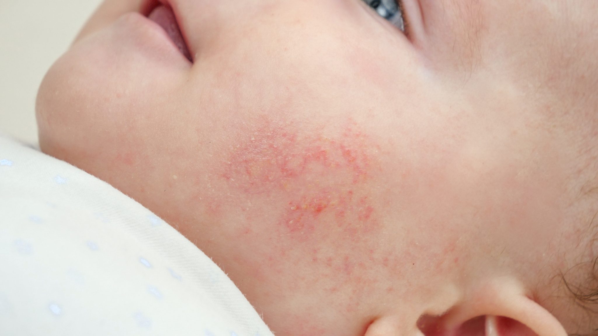 Baby's First Year: Navigating Common Pediatric Skin Issues