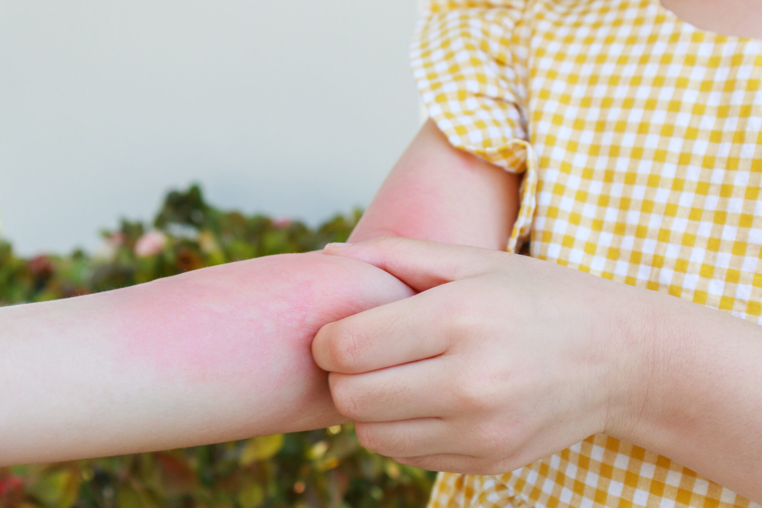 Managing Childhood Eczema: What Parents Should Know | Plymouth Meeting ...