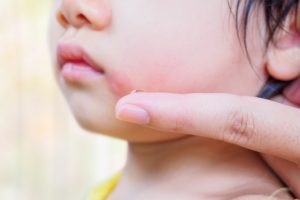 Rash Around a Child’s Mouth? Could Be Perioral Dermatitis.
